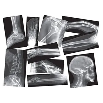 Broken Bones X-Rays - 15 sheets